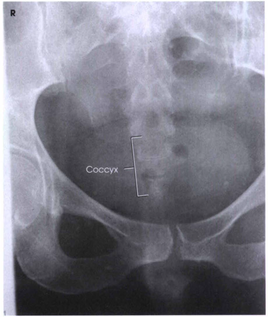 AKHSANUR BLOG'S: teknik radiografi sacrum dan coccyx