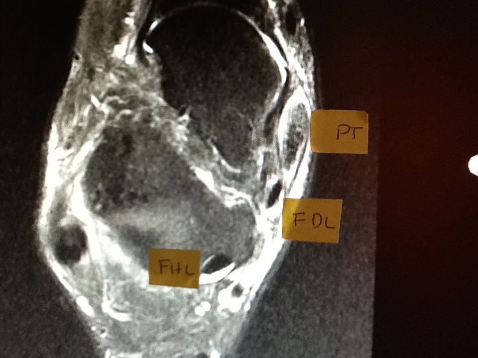 Foot and Ankle Problems By Dr. Richard Blake: Posterior Tibial Tendon ...