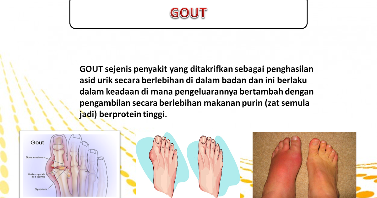 Mewah Ilmu: GOUT: PUNCA DAN PENAWARNYA