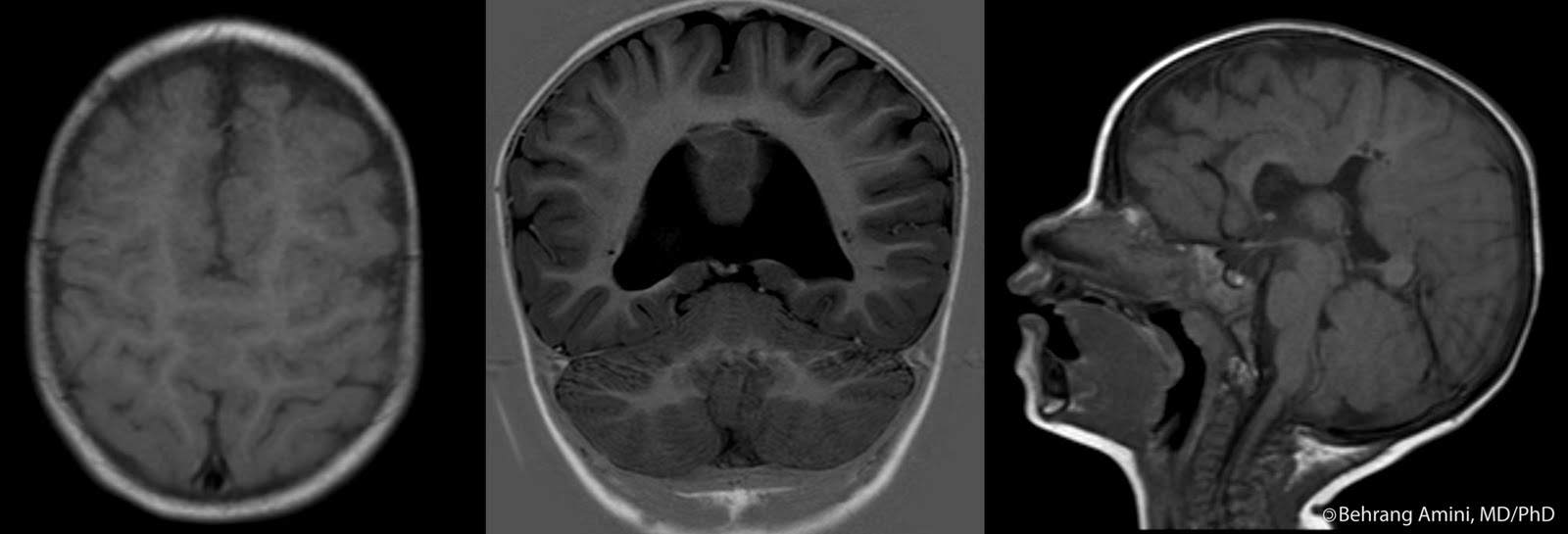 Roentgen Ray Reader: Syntelencephaly