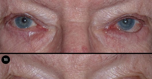 What Is Entropion? - Teroes