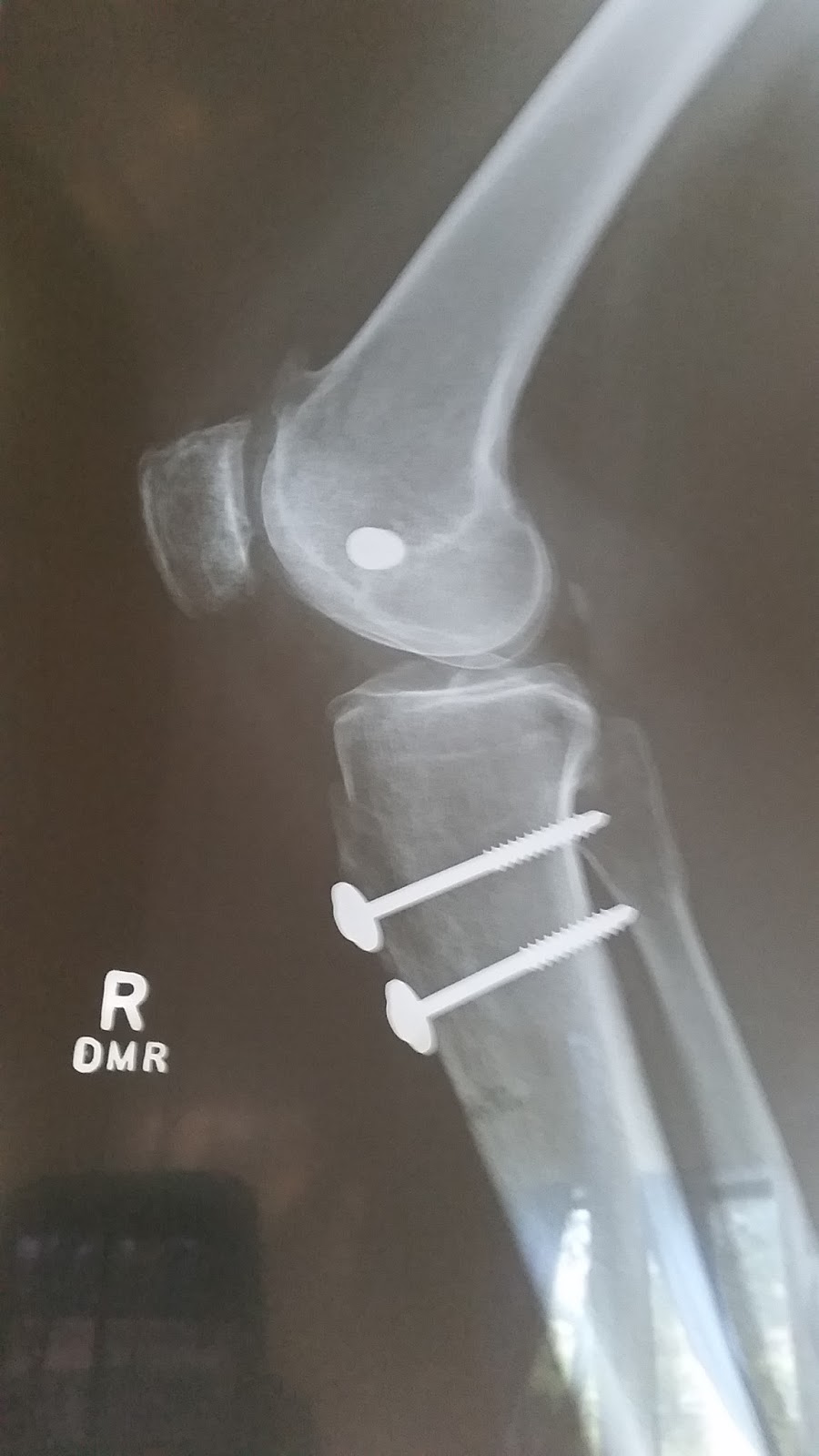Journey of a Medial Patello-Femoral Ligament repair and Tibial Tubercle ...