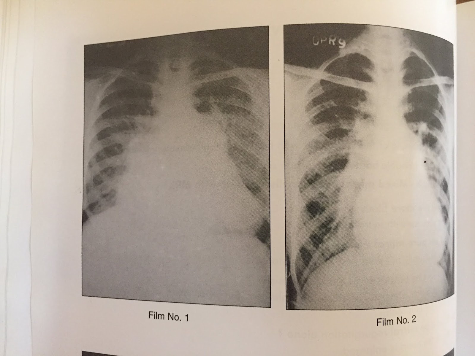 XRAYS OF SHUNT ANOMALY