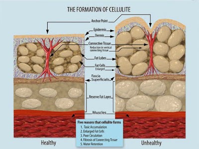 ΕΥίασις Ear nose & throat IΝSTITUTE : Cellulite Acupuncture