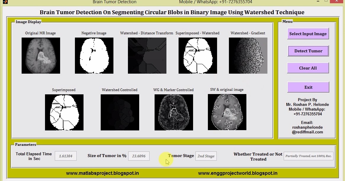 Matlab Project for Brain Tumor Detection Using Watershed Technique Full ...