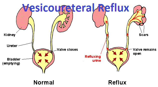 Vesicoureteral Reflux (VUR)