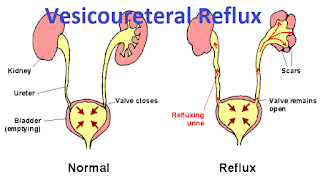 Vesicoureteral Reflux (VUR)