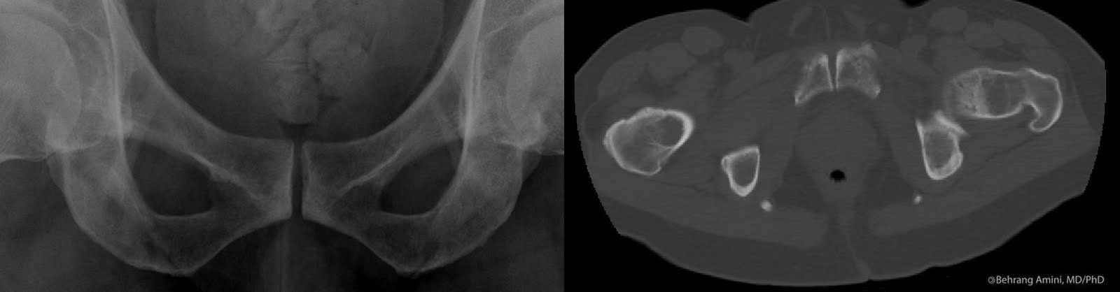 Roentgen Ray Reader: Ossification of the Sacrotuberous Ligaments