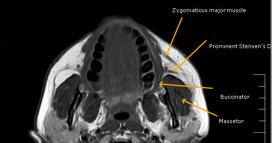 Stensen's Duct-MRI - Sumer's Radiology Blog