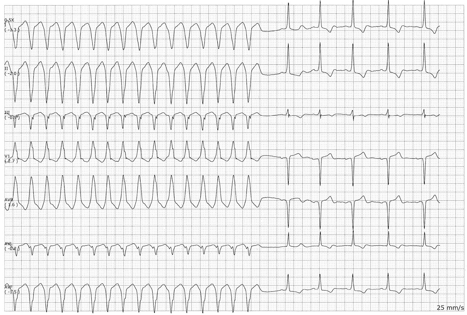 Ventricular Tachycardia