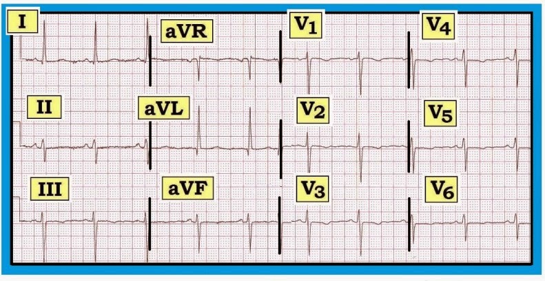 Normal ECG & electrocardiography principles : 네이버 블로그