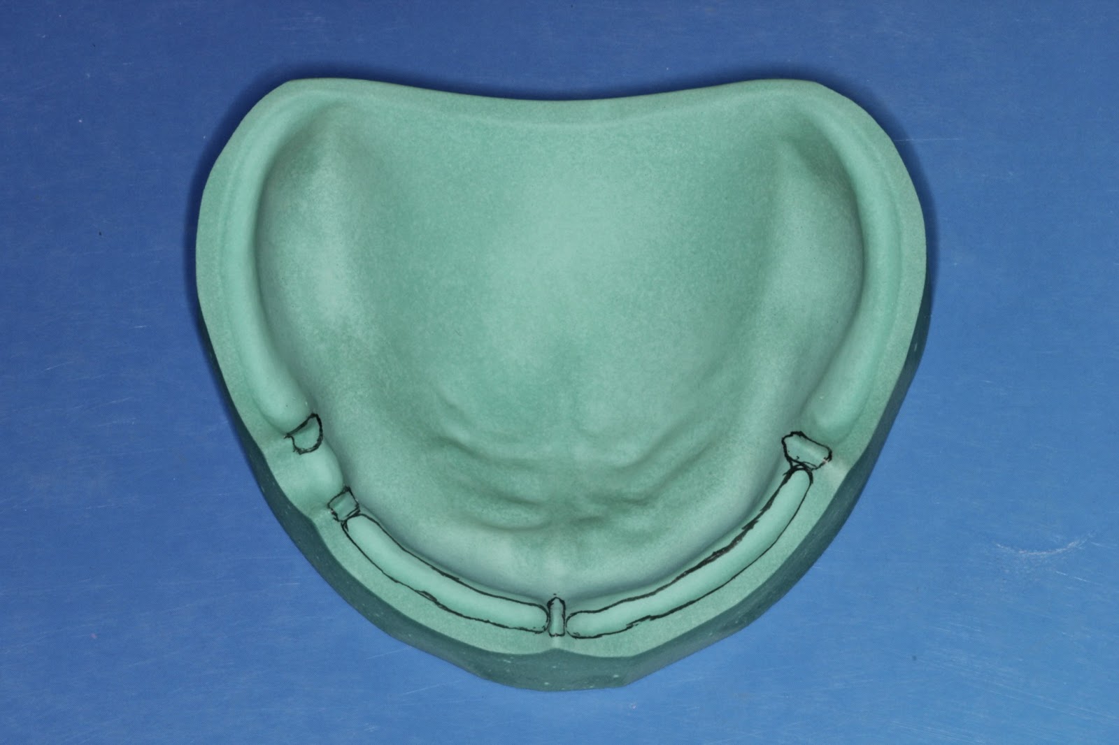 Understanding Prosthodontics - Tagore Dental College & Hospital-By ...