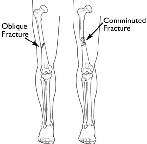 Oblique bone fracture - intseka