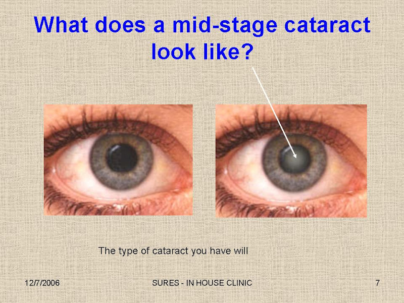 JUST TO SHARE (Lau Tai Onn): Cataracts