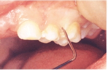 hiphoplife: Intrapapillary injection technique for children