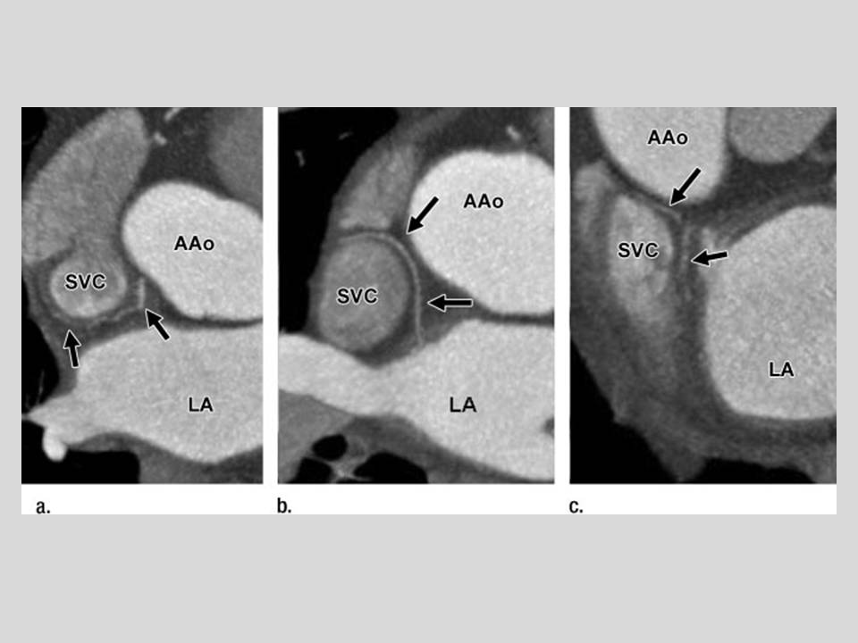 The Pump and the Tubes: The SA Node Artery