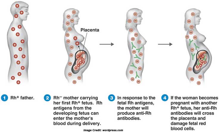 Know your genotype and rhesus factor before marriage. Incompatibility ...