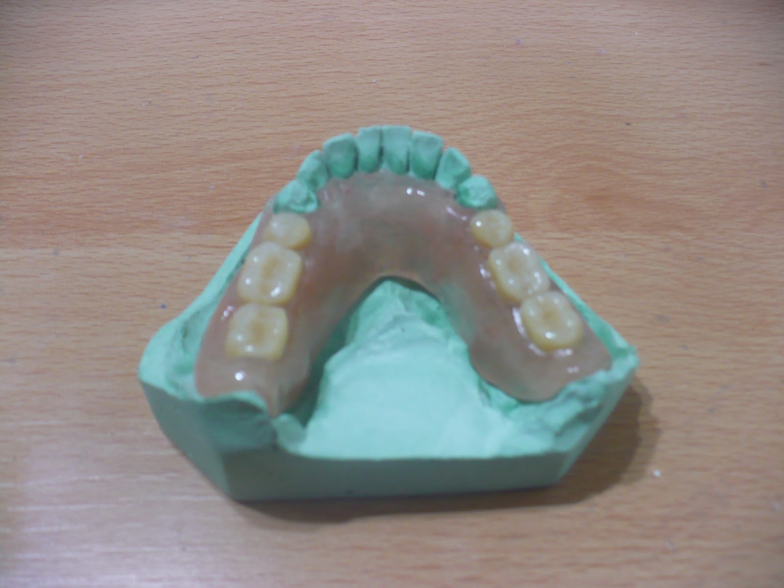 Laboratorio Dental Fernando Emmanueli: Protesis Parcial Deflex