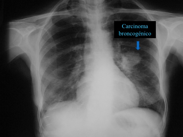 Anatomía : Caso clínico: Cáncer de Pulmón