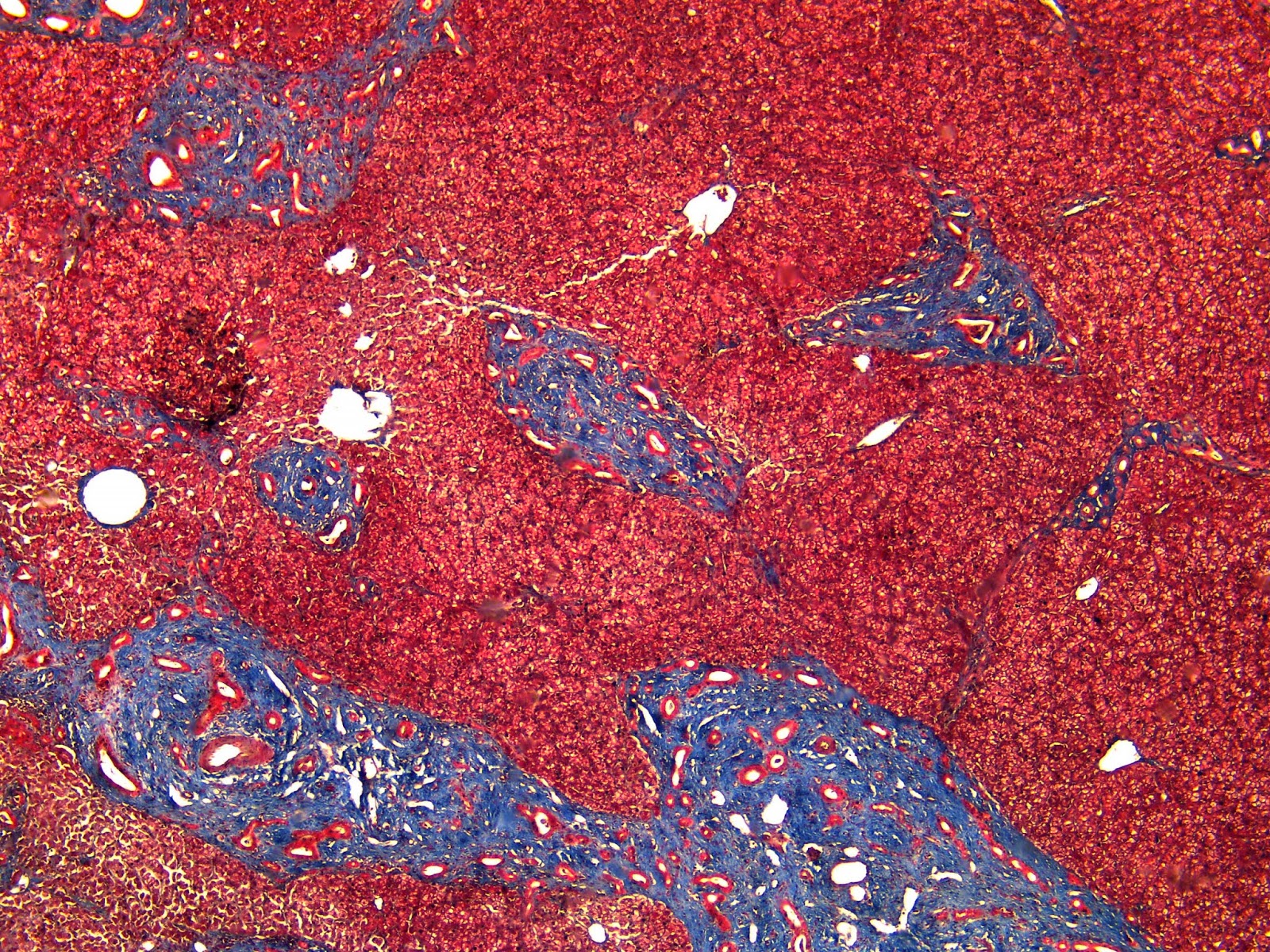 Patología CC: Fibrosis hepática congénita / congenital hepatic fibrosis