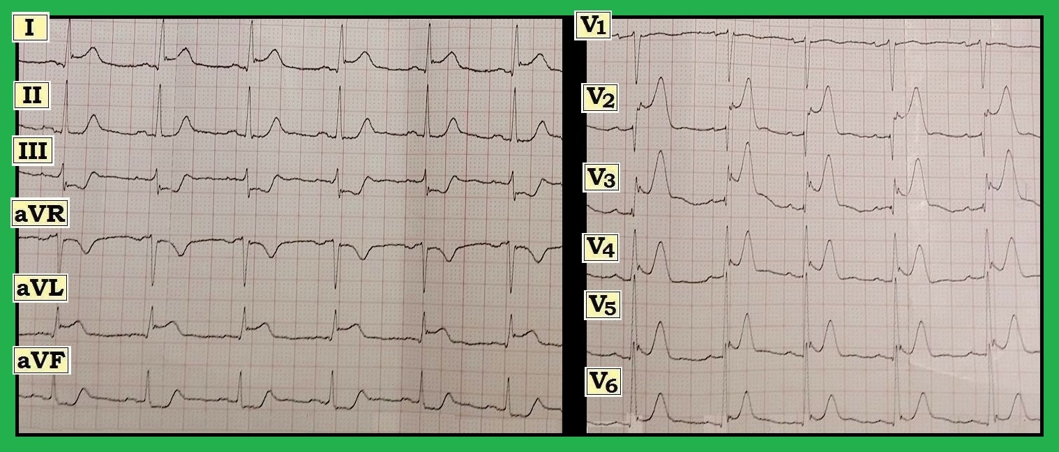 ECG Interpretation: ECG BLOG #115 (Early Repolarization — Peaked T ...
