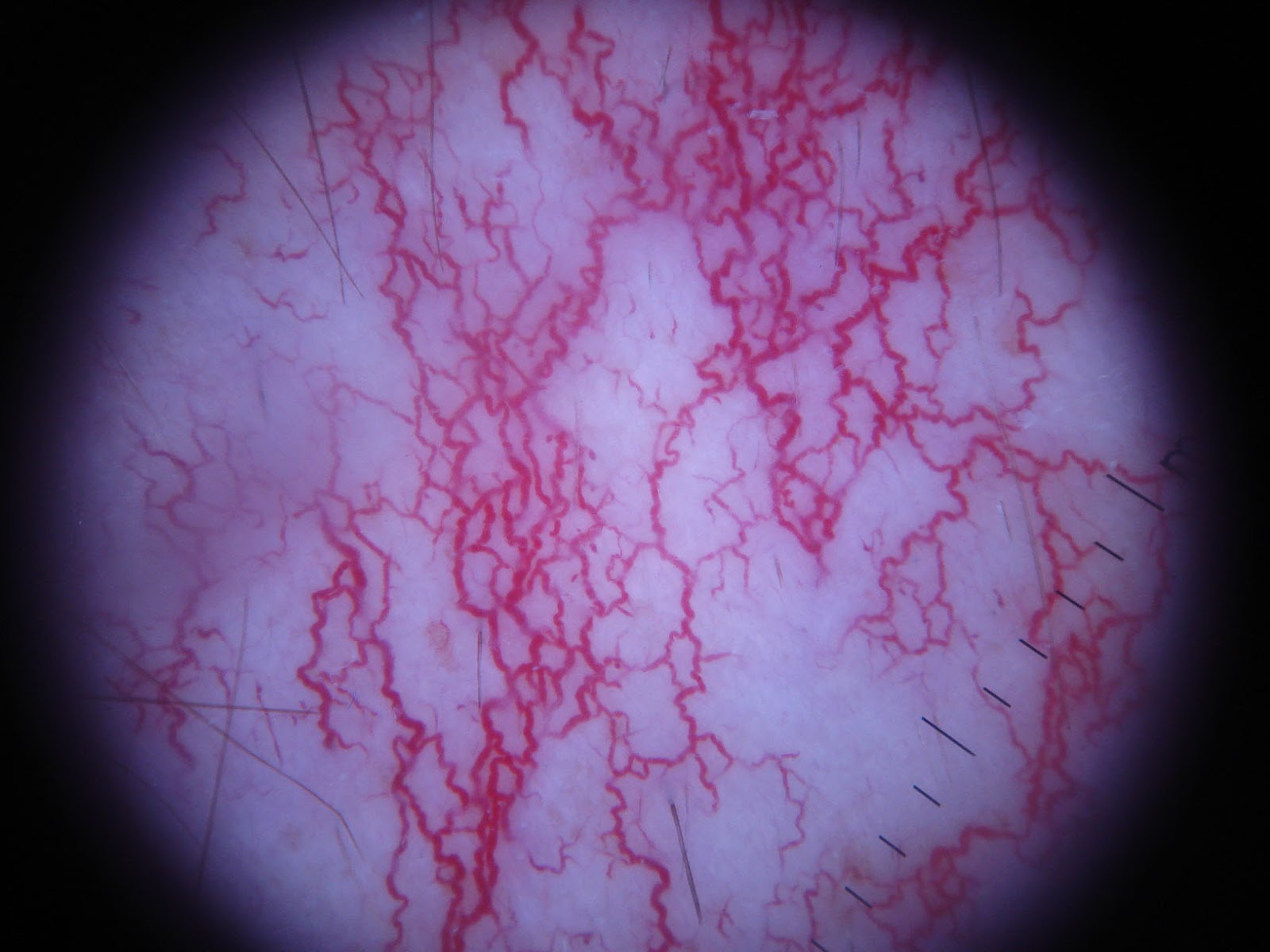 VIRTUAL GRAND ROUNDS IN DERMATOLOGY 2.0: Unusual Vascular Pattern