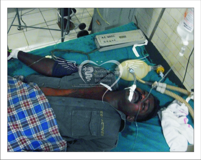 Snakebite a Neglected Tropcal Disease