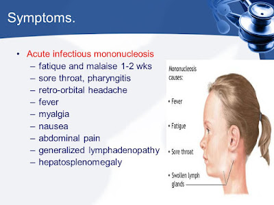 Pediatrics Notes: Clinical Features of Infectious Mononucleosis