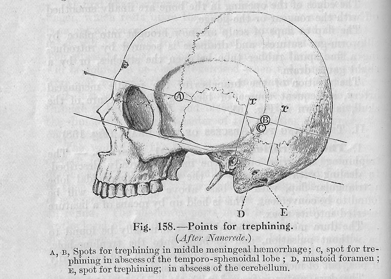 Western Fictioneers: WE'LL HAVE TO OPEN HIS HEAD UP!