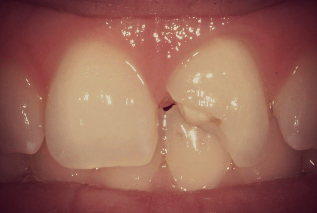 TOOTH GERM: A Guide to Dental Trauma in Children