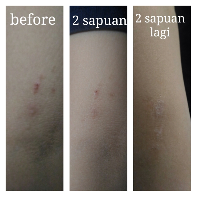 HILANGKAN PARUT DENGAN CZER SCAR POWDER