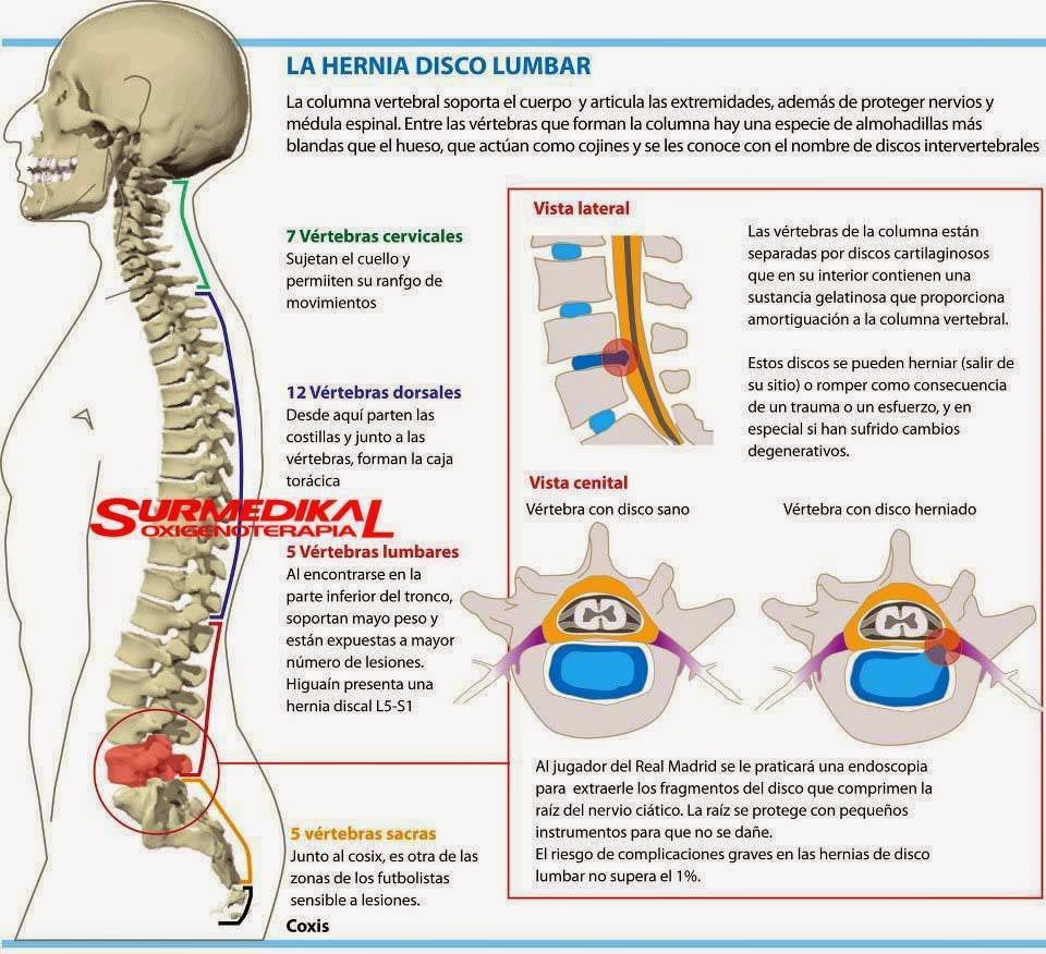 BLOG DE EDUCACIÓN FÍSICA por Jesús Madrid Boyero: LA HERNIA DISCO LUMBAR