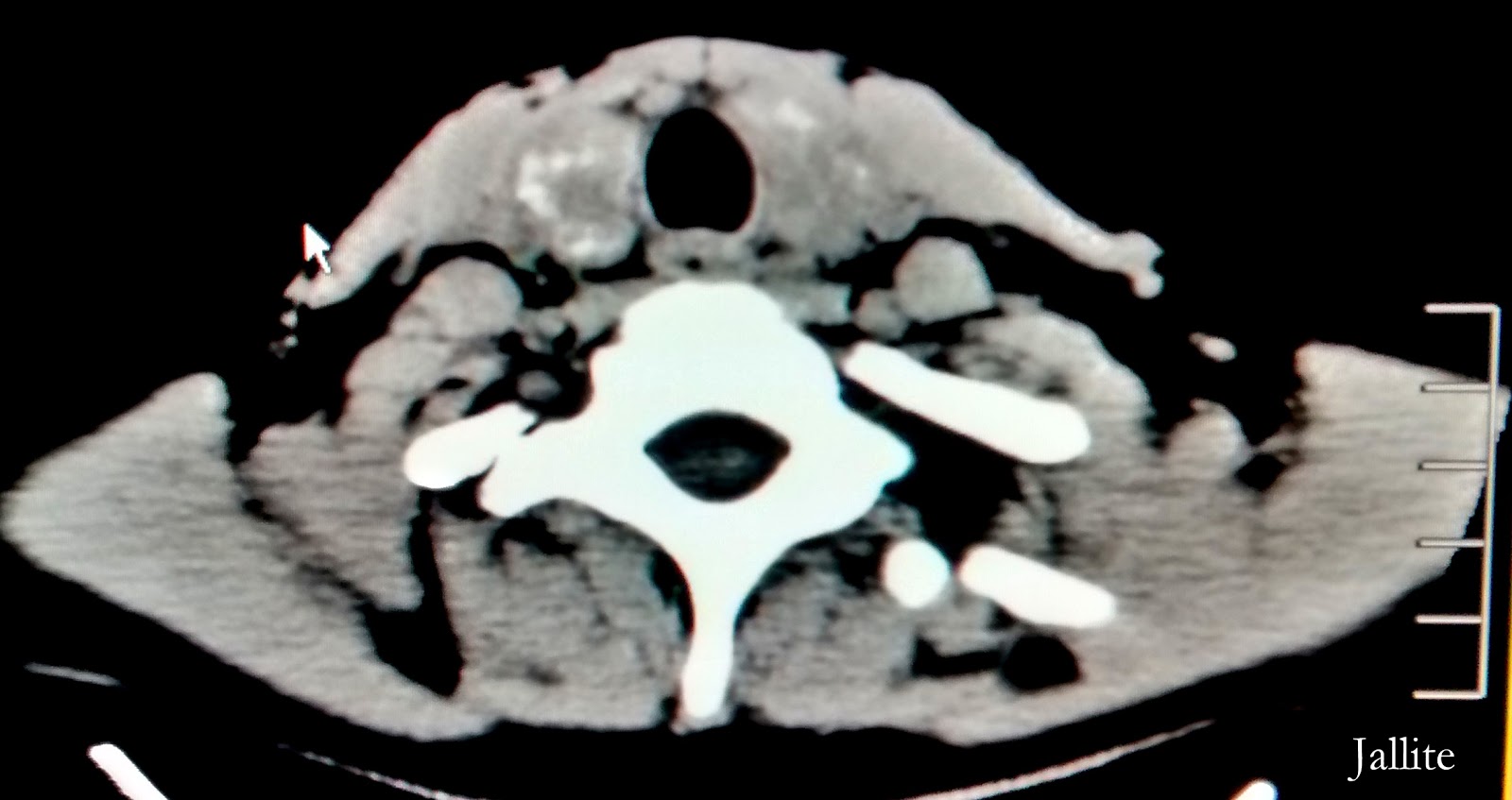 Tiroiditis Subaguda