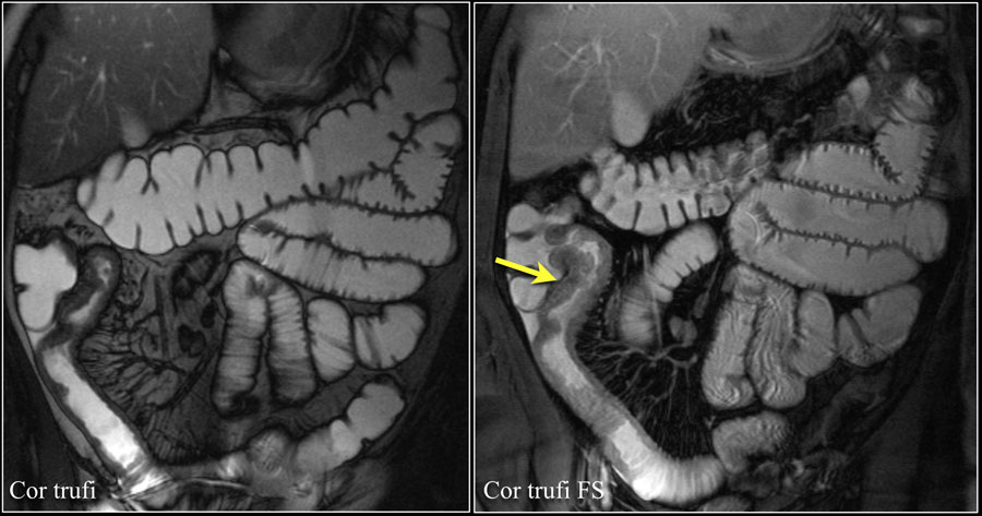What does Crohns Disease look like
