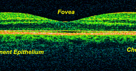 Infrared 100: Near infrared optical coherence tomography