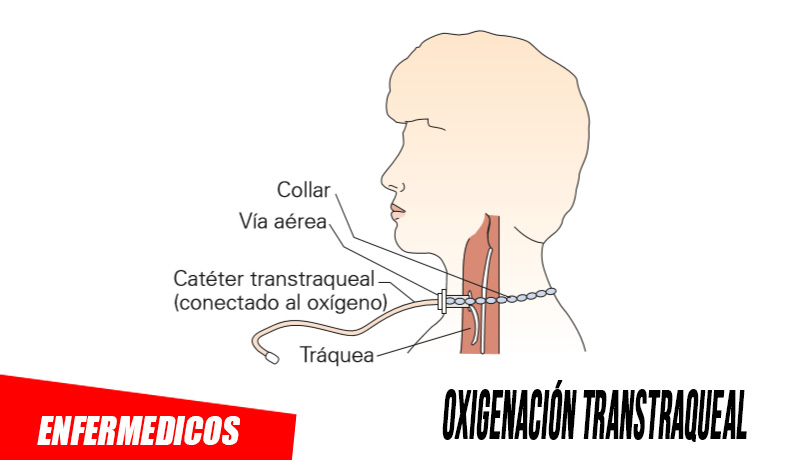 ENFERMERÍA MI PROFESIÓN: EQUIPO PARA ADMINISTRACIÓN DE OXÍGENO