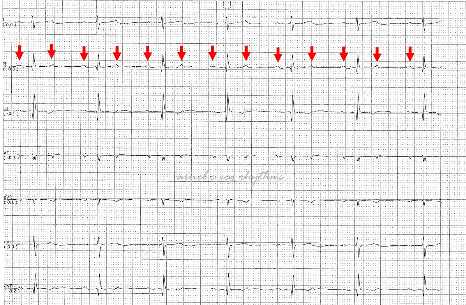 ECG Rhythms: Complete Heart Block or Not?