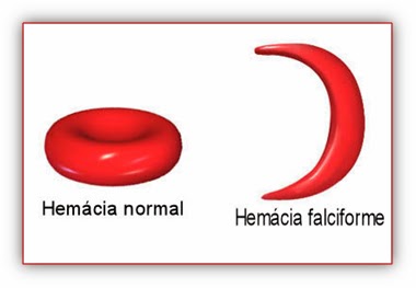 Anemia Falciforme ~ Fisioterapia Saúde & Reabilitação