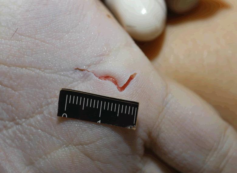 Deformutilation: Forensic Hand Trauma