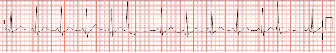 EKG Rhythm Strips 36