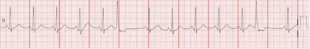EKG Rhythm Strips 36
