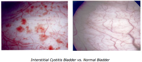 Interstitial Cystitis & Lung Transplant: My Life Battling Disabling ...