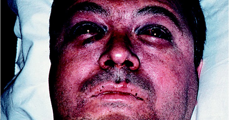 ASSISTENZA SANITARIA OSS: cianosis