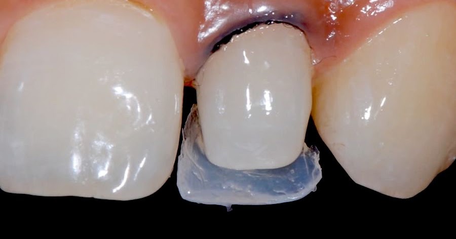 OPERATIVE DENTISTRY: Anterior Composite Layering of a Peg Lateral ...