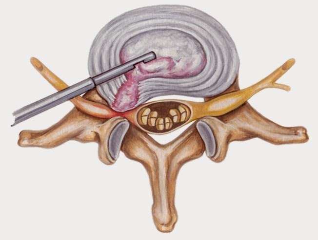 Spine Surgery and Treatment in India : Minimally Invasive spine surgery ...