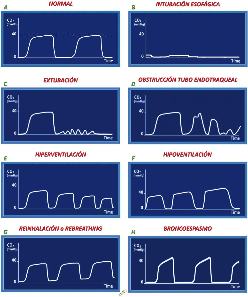 Capnografia Para Que Serve - RETOEDU