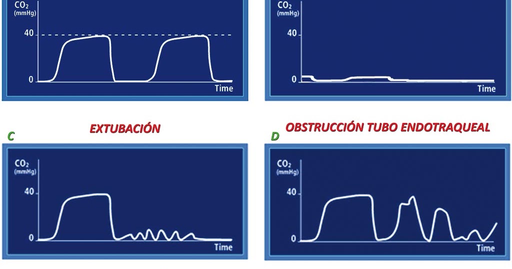 Urgencias y emergencias: La capnografía en Urgencias y Emergencias