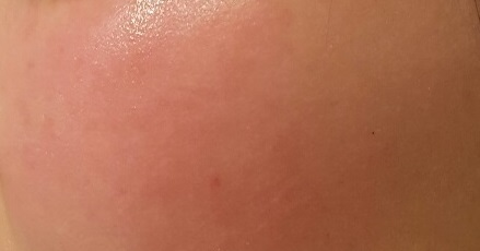 Irene dematology story: Recognize about the facial flushing (By CNP ...