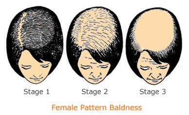 hair loss: Female Pattern Baldness