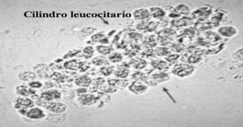 Examen de orina: Cilindros